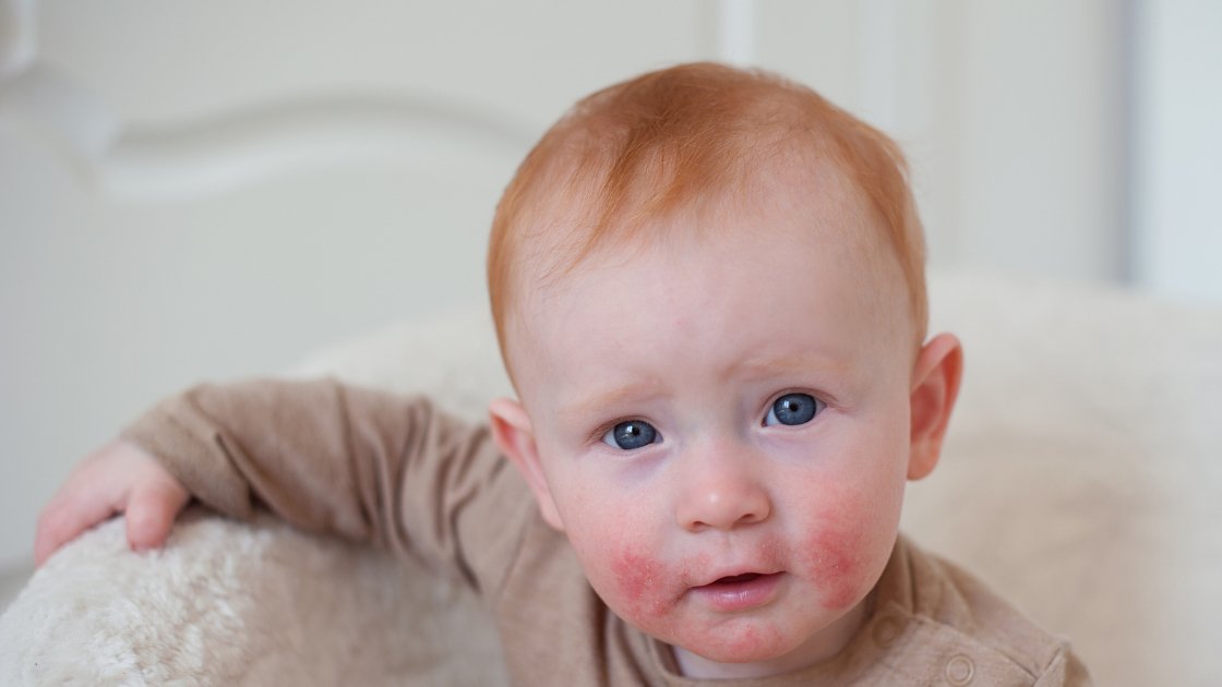 Stop the Atopic March – Yobee Care